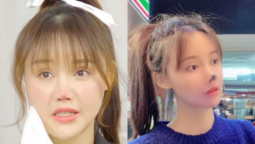 Los horrores que vivió la actriz Gao Liu tras cirugía plástica